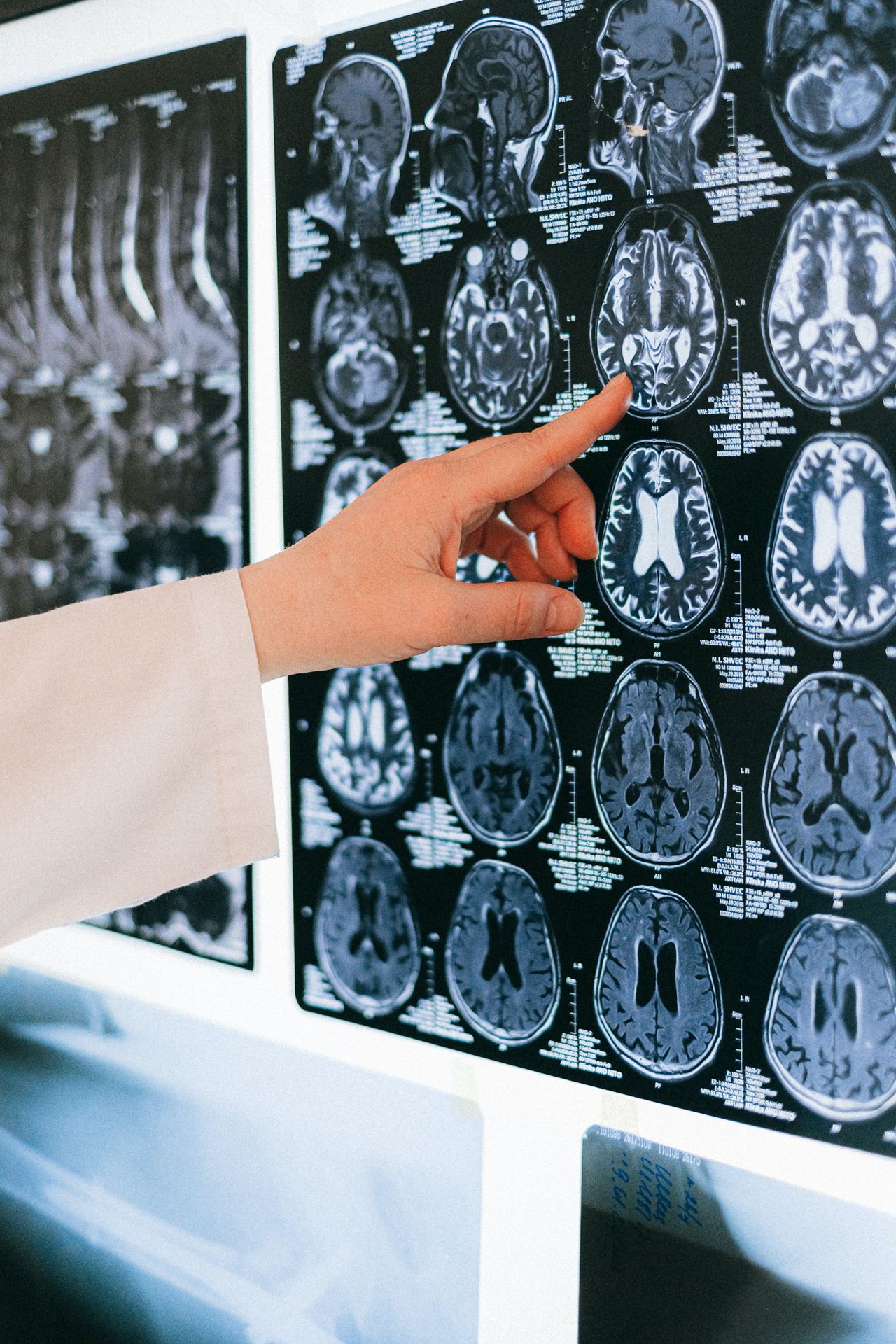 Understanding Your Brain MRI Results: Common Misdiagnoses & Importance ...